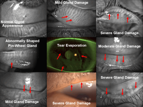 Envision by Inmode: Advanced Dry Eye and MGD Treatments